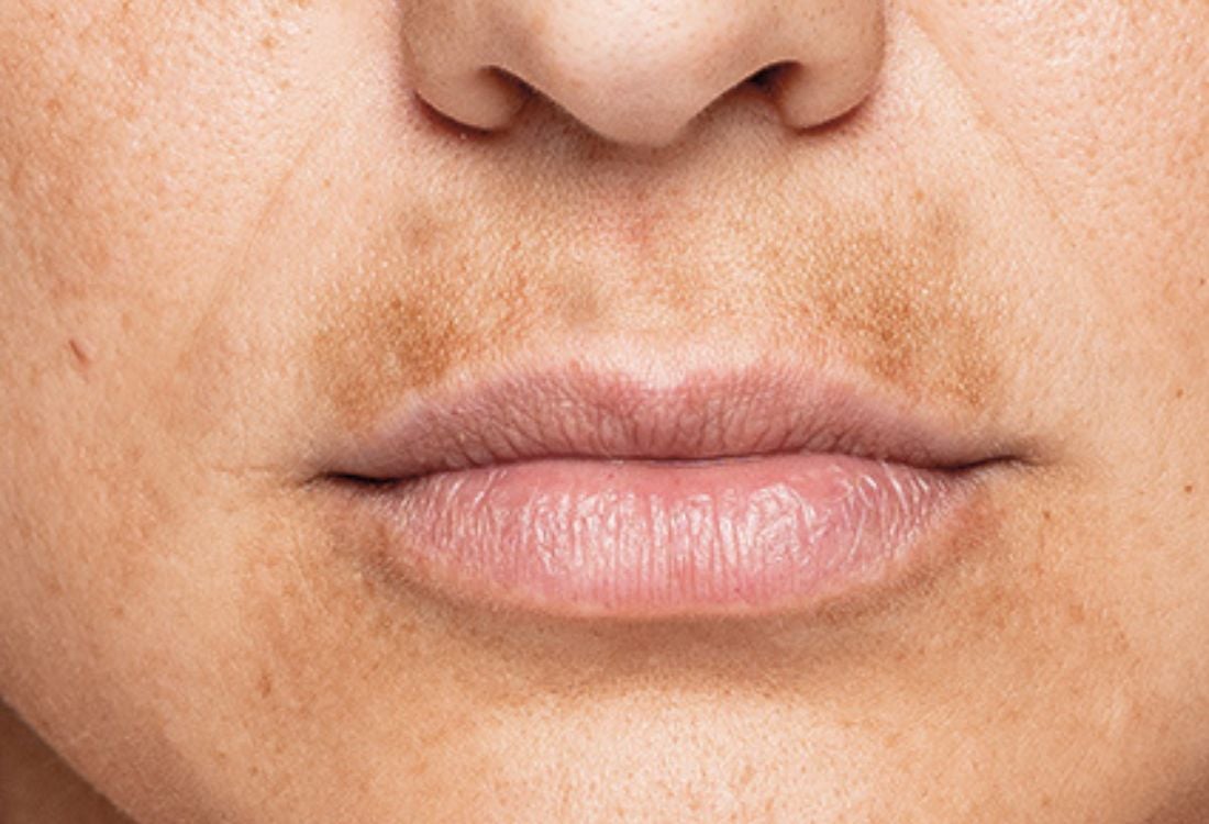 Pigment Therapy, depigmenting professional treatment Germaine de Capuccini